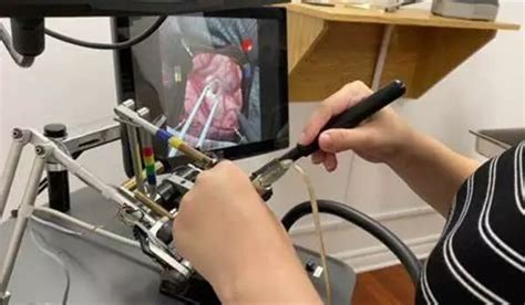 Unintended Implications In Artificial Intelligence Based Neurosurgical Training Assignment Point