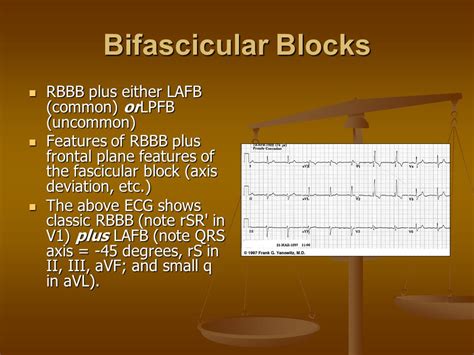 Sino Atrial Exit Block Sa Block Ppt Download