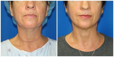 Chinsculpttm Chin Liposuction Houston Lipo Center