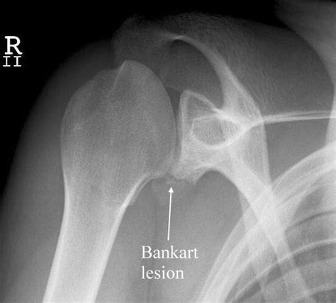 Bankart Lesion • Litfl • Medical Eponym Library