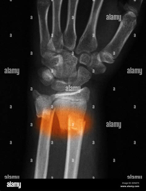 Ulna Fracture X Ray Distal Radius And Ulna Fractures Radiology Case
