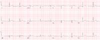 Hyperacute T Waves And Occlusion Mi Ecg Cases Emergency Medicine Cases