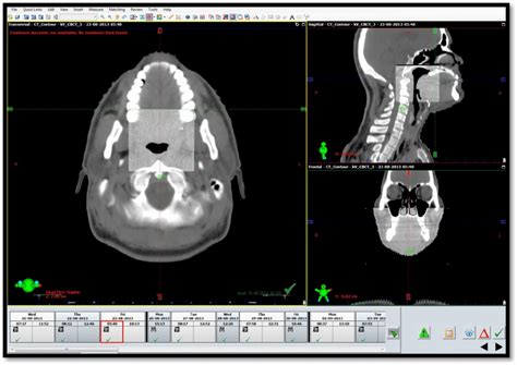 Cone Beam Radiation Therapy The Best Picture Of Beam