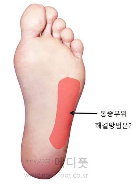 블라인드 블라블라 발바닥 통증… 갑자기 어제부터 아픈데 족저막근염이야ㅠㅠ