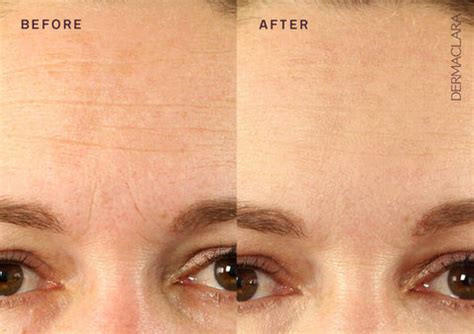Understanding Sebum Its Impact On Skin Health And Care Dermaclara