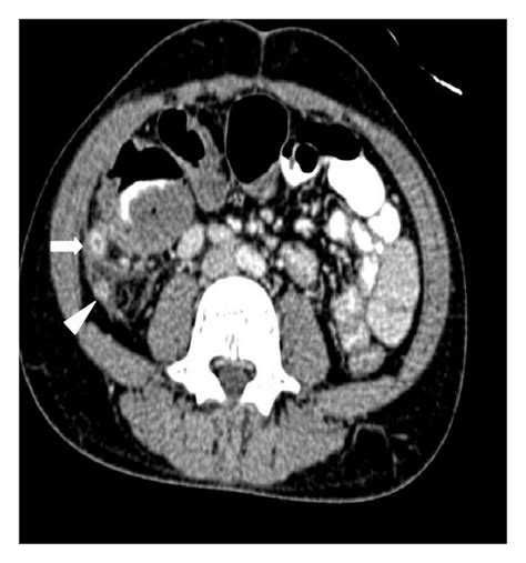 Contrast Enhanced Ct Showing Long Inflamed And Retrocaecal Appendix Download Scientific
