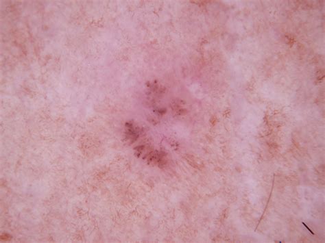 Skin Lesions Val Object Detection Dataset By Dmduke