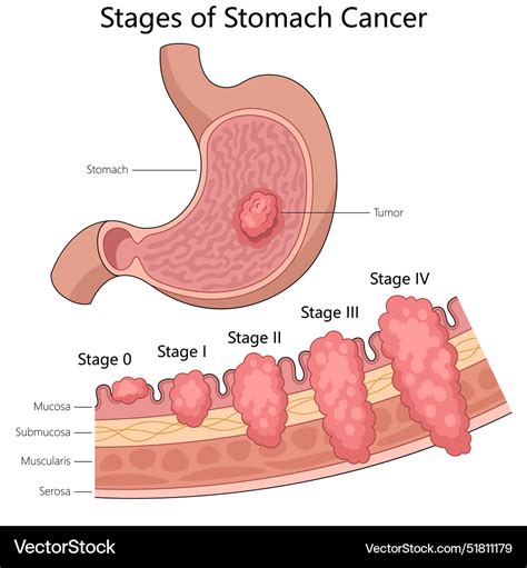 Gastric Cancer Diagram Full Article Immunotherapy For Gastric Cancer