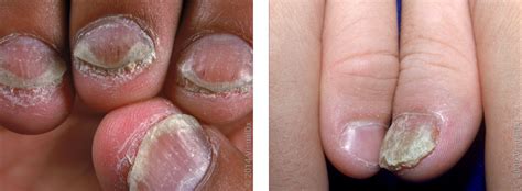 Psoriasis Nails Vs Fungus Pictures And Differences To Look For Goodrx