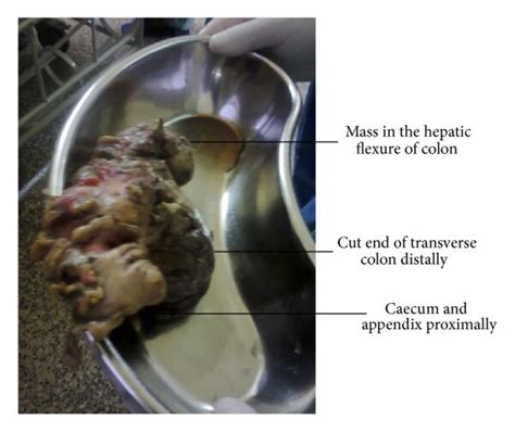 Intraoperative Appearance Of Inflammatory Fibroid Polyp Arising From