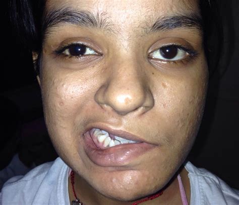 Hypoglossal Nerve Dysfunction