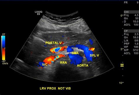Nutcracker Syndrome A Simplified Approach With Gonadal Vein