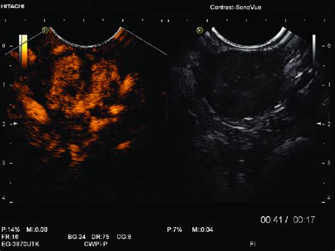 Gastrointestinal Stromal Tumors In Contrast‑enhanced Endoscopic Download Scientific Diagram