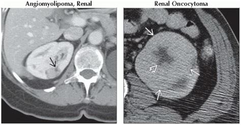 Da15 Db1 Solid Renal Mass Ffu6  Abdominal Key
