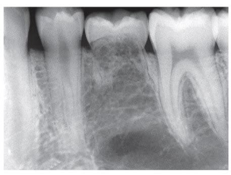Abnormalities Of Teeth Part Ii Flashcards Quizlet