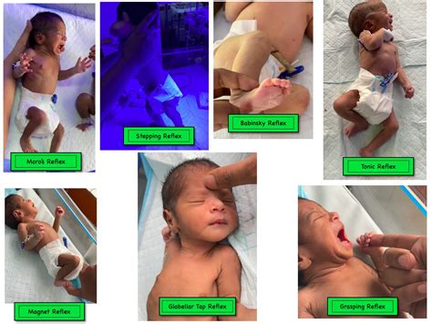 Newborn Reflexes Ppt Neonatal Reflexes Powerpoint Presentation