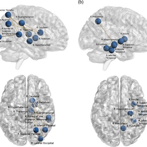 visual spatial memory‐associated networks lesion‐based wm tract