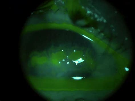 Cornea And Anterior Segment Imaging Epithelial Pooling Vs Staining In