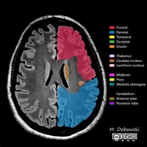 Ct Anatomy Of Brain Lobes At Sandra Karcher Blog
