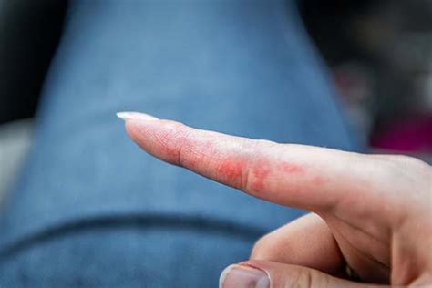Dyshidrotic Eczema Effective Management Strategies Harvard Health