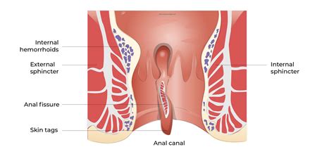 Anal Fissure Coloproctologie