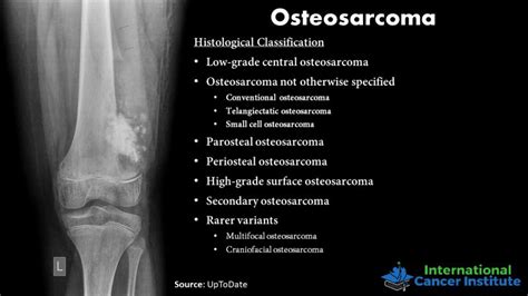 Osteosarcoma Sarcomaawarenessmonth International Cancer Institute