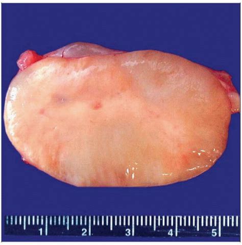 Neurofibroma Basicmedical Key