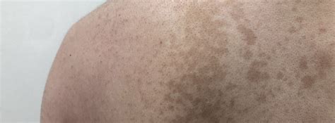 Pitiriasis Versicolor¿es Una Enfermedad Contagiosa Canalsalud