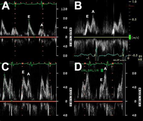 Diastolic Function Evaluated With Pulse Doppler Of The Mitral Infl Ow