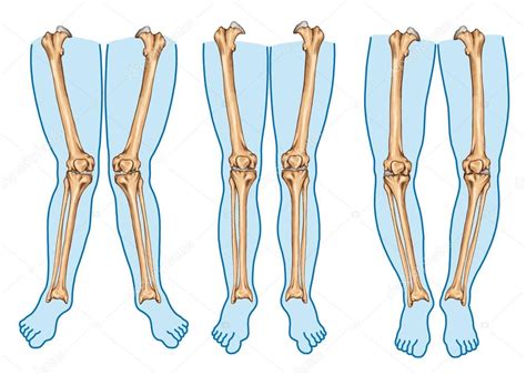 Images Genu Valgum Genu Varum Genu Valgum A Physical Legs Deformity Bowing Of The Leg In Images Genu Valgum Genu Varum Genu Valgum A Physical Legs Deformity Bowing Of The Leg In
