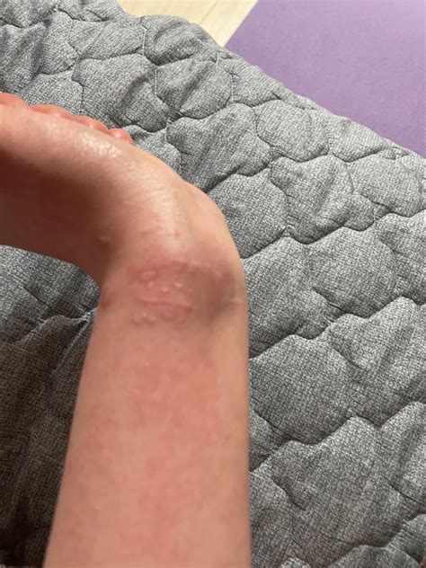 이런 것은 무엇인가요 병원에 가봐야 하나요 ㅣ 궁금할 땐 아하