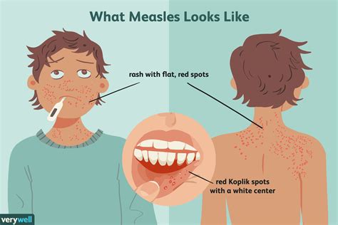 Effects Of Measles On Humans Measles Complications Nbcs