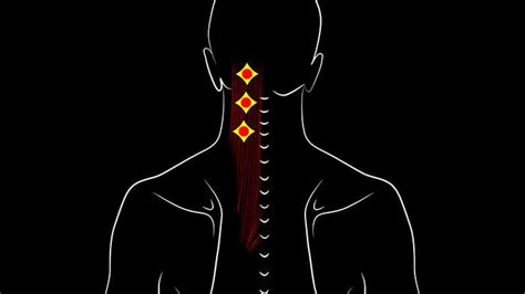 Semispinalis Trigger Points And Muscle Pain Dr Chernov
