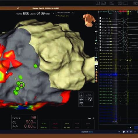 Late Potentials During Left Ventricular Pacing Download Scientific Diagram