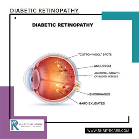 Diabetic Retinopathy Treatment In Mumbai By R And R Eye Care Hospital