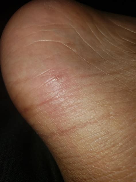 What Is This I Got It Indoors It Initially Looked Like A Mosquito Bit And Felt Like One But