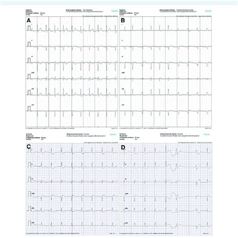 Patients With Delayed Conduction Disturbances Post Tavr Leading To Ppm