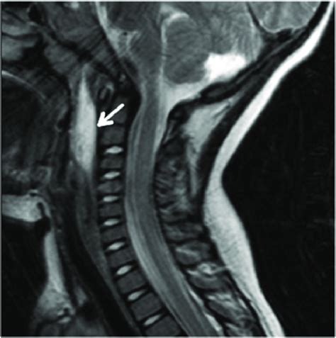 Magnetic Resonance Image Of The Cervical Spine Sagittal View Showing