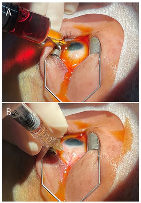 Intravitreal Injection