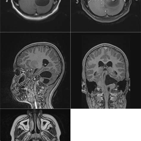 Overview Of Choroid Plexus Tumors Download Table