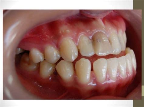 3 Management Of Angles Class Iii Malocclusion