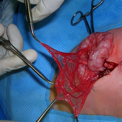 Case 1 Exposure Of The Greater Omentum Revealing The Macroscopic