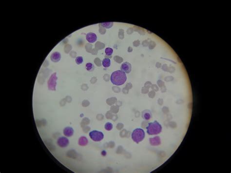 Próeritroblasto Diâmetro 16 A 20µm Alta Relação Núcleoc Flickr