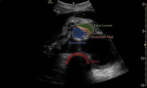 Aortic Dissection Case Report Us Transverse 1 Annotated Jetem 2023