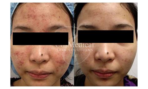 Jessner Peel Perth Chemical Peel Perth Cosmedical Skin Solutions
