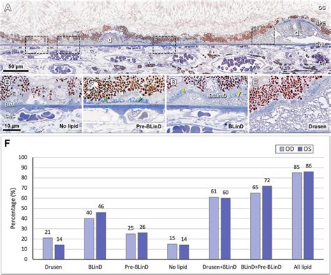 Distribution Of Sub Rpe Bl Lipid In Early Amd Eye 63 A A Panoramic