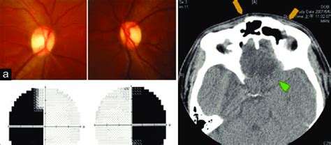 A Fundus Examination Revealed Bilateral Bow Tie Shaped Optic Atrophy Download Scientific