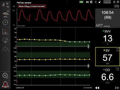 Flotrac Sensor Edwards Lifesciences