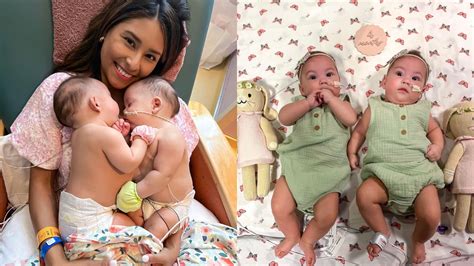 Formerly Conjoined Twins Home From Hospital After Successful Separation Surgery