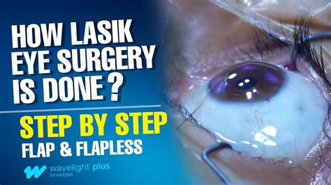 Lasik Eye Surgery Flap And Flapless Step By Step Youtube